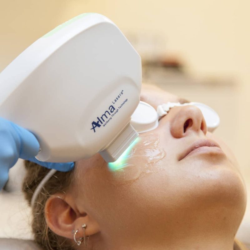 IPL behandeling | Aesthetic Art Valkenburg